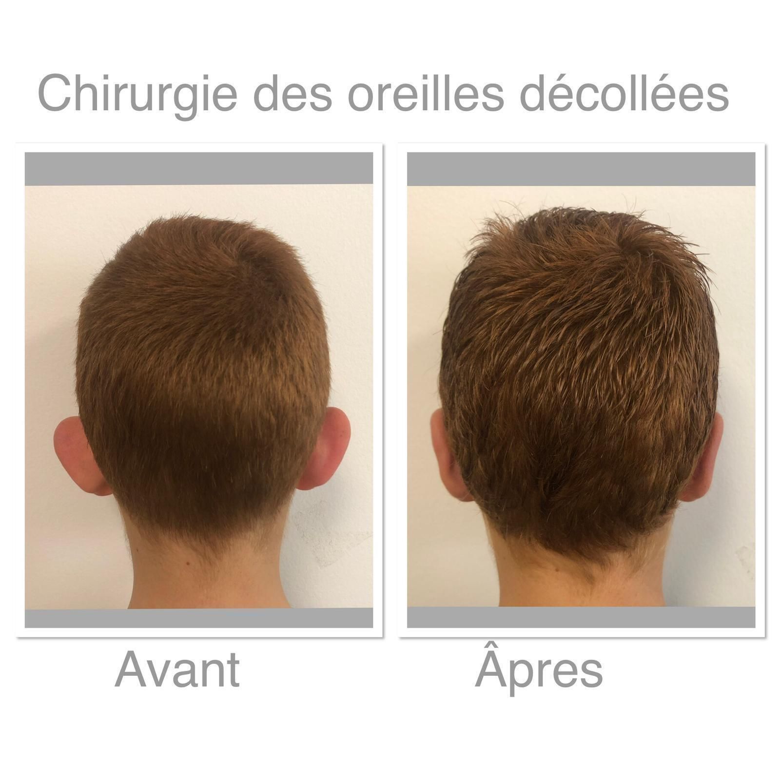 Otoplastie Avant et après - Multiesthetique.fr