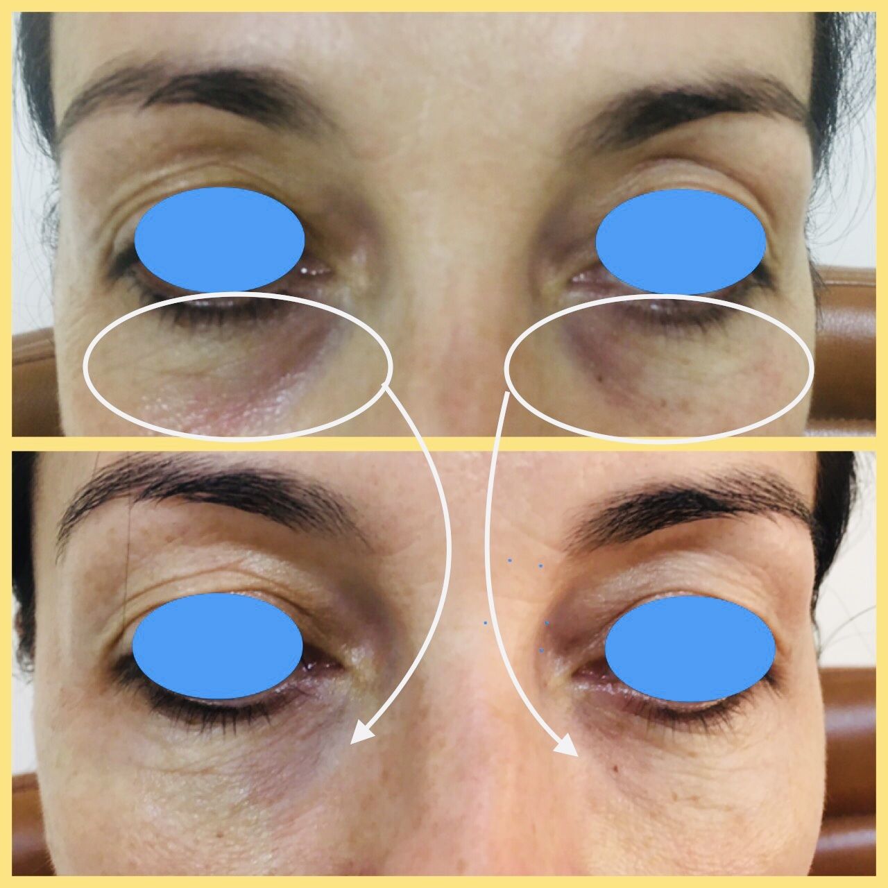 Cernes Avant et après - Multiesthetique.fr - Multiesthetique.fr