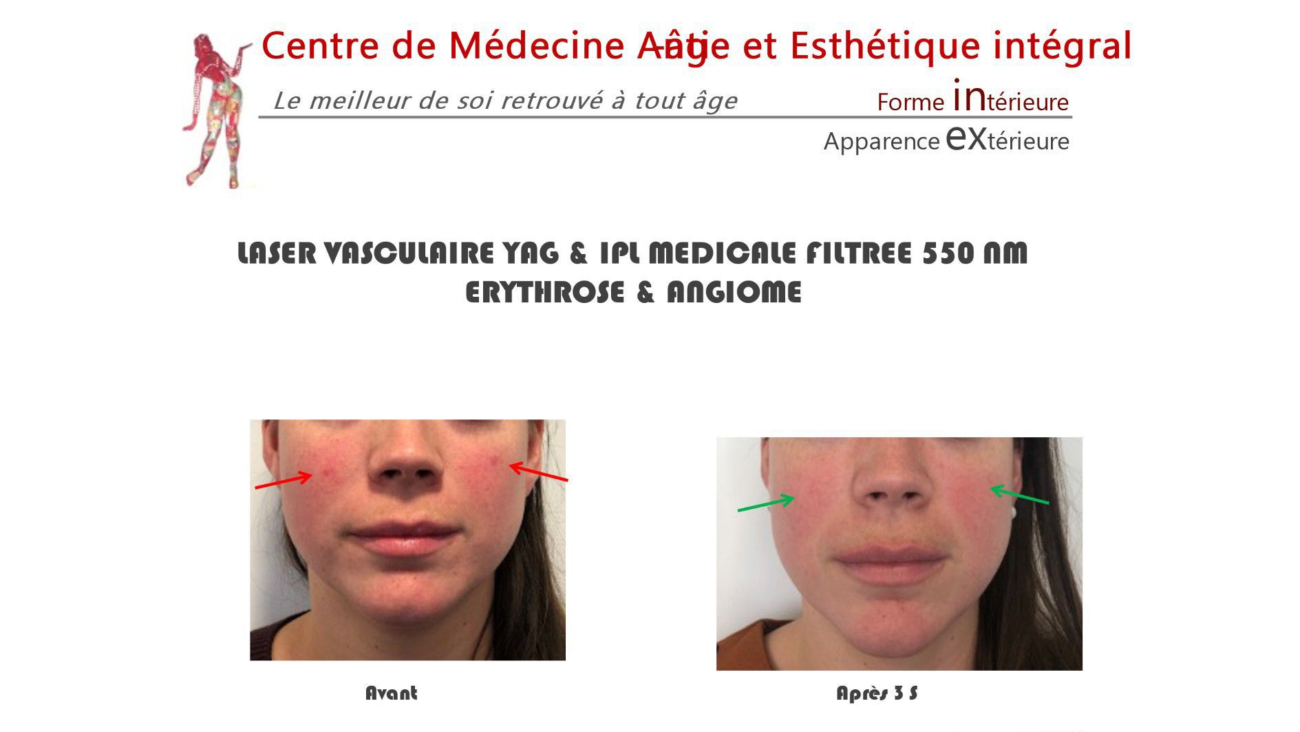 Taches pigmentaires Avant et après - Multiesthetique.fr