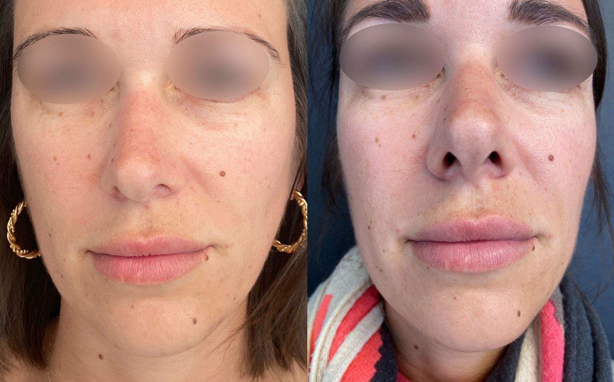 Botox Avant et après - Multiesthetique.fr - Multiesthetique.fr