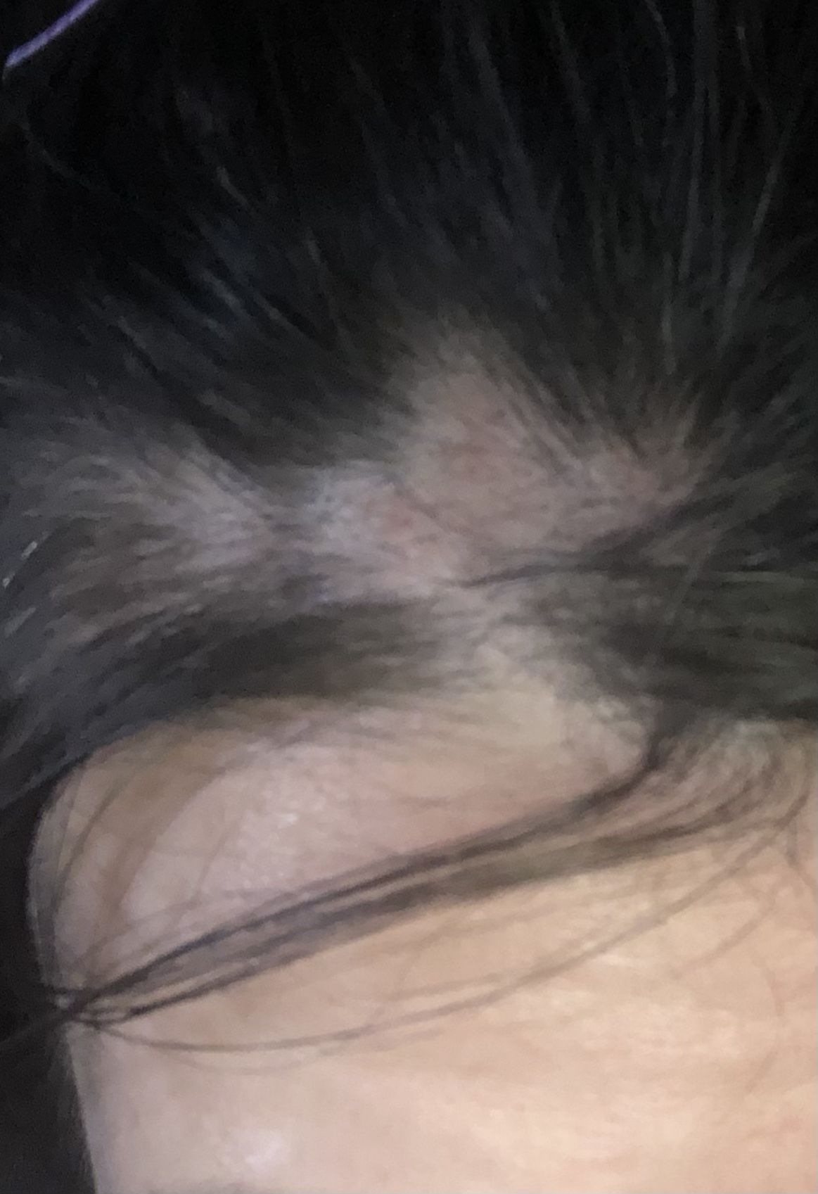 Injection acide hyaluronique pour corriger bosse frontale, j’ai une ...