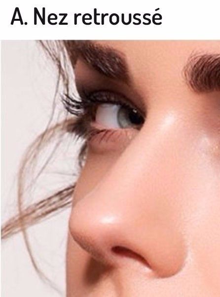 Nez retroussé ou plat ?, May_Multiesthetique, nov. 2018