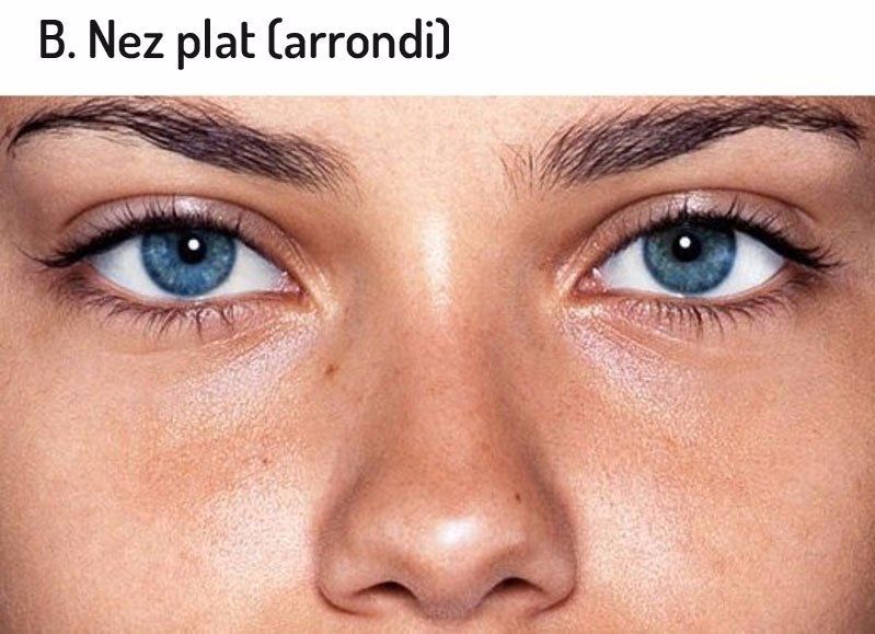 Nez retroussé ou plat ?, May_Multiesthetique, nov. 2018