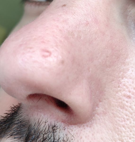 Papule Fibreuse nez----, DamienR, août 2020