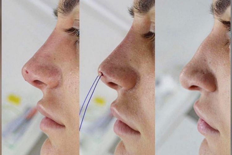 Fils tenseurs crantes NEZ - Multiesthetique.fr