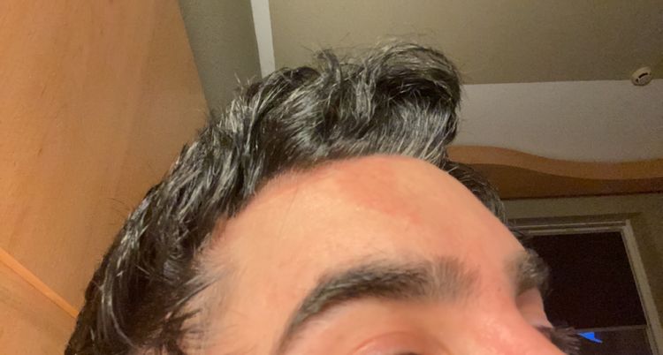 Tache rose sur le front - Multiesthetique.fr