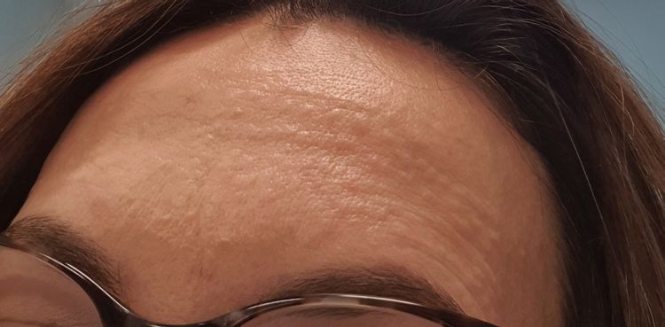 Irrégularités front suite à des injections d'acide hyaluronique ...